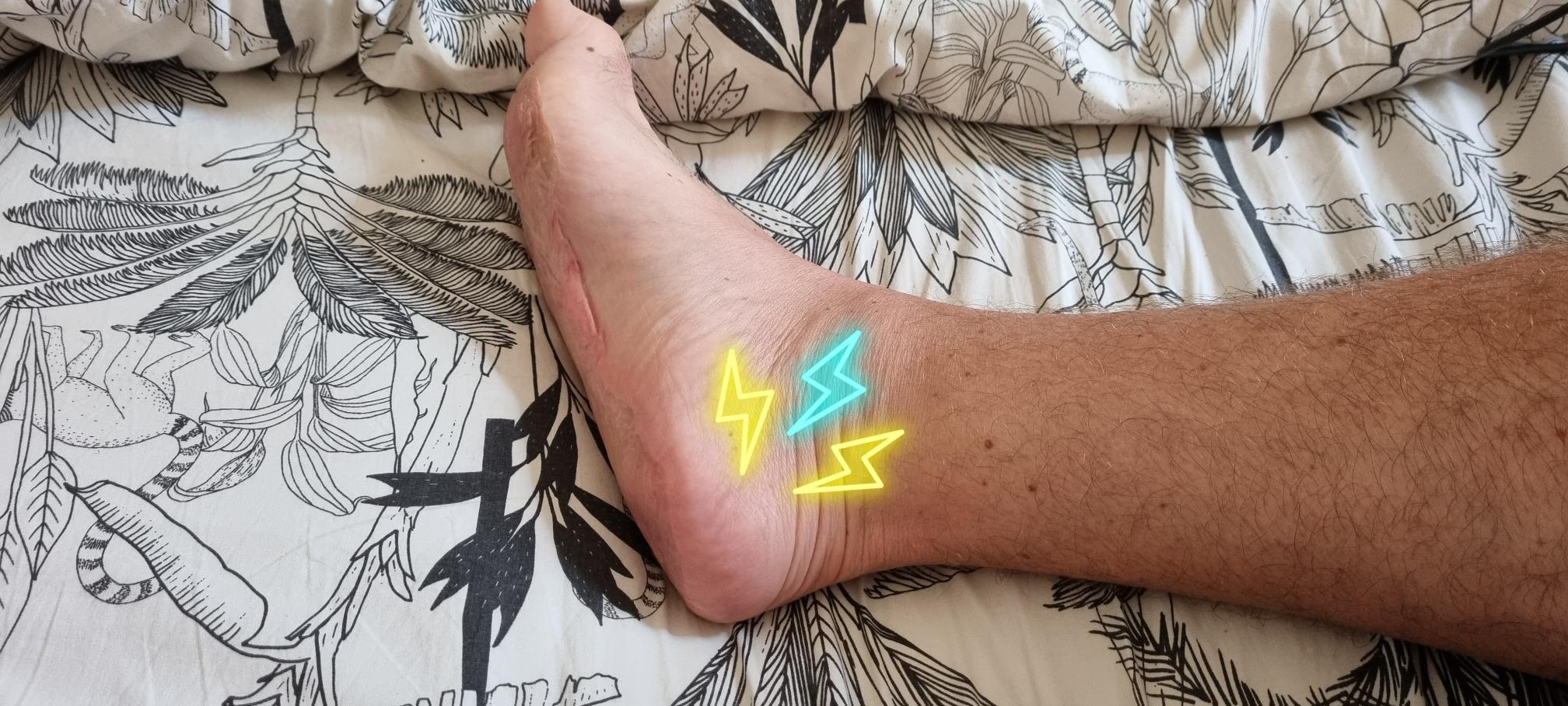 Pied cassé - Du nOOOrd au sud